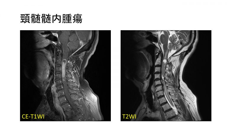 脊髄腫瘍（硬膜外、硬膜内髄外、髄内腫瘍） 東京医科大学 整形外科学分野