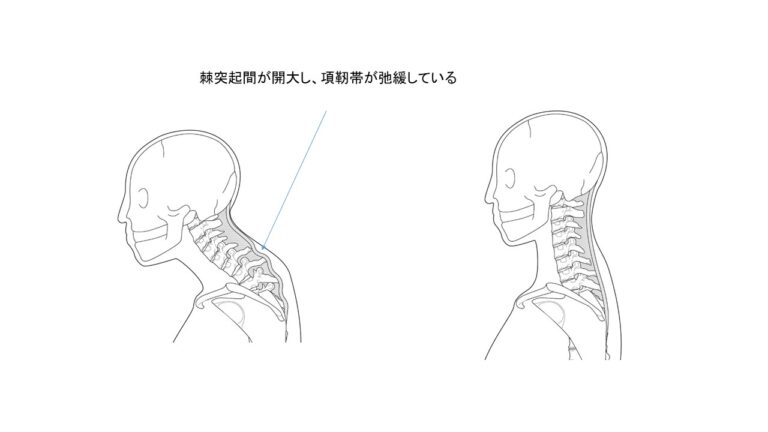Dropped head syndrome (etiology and solution) | 東京医科大学 整形外科学分野
