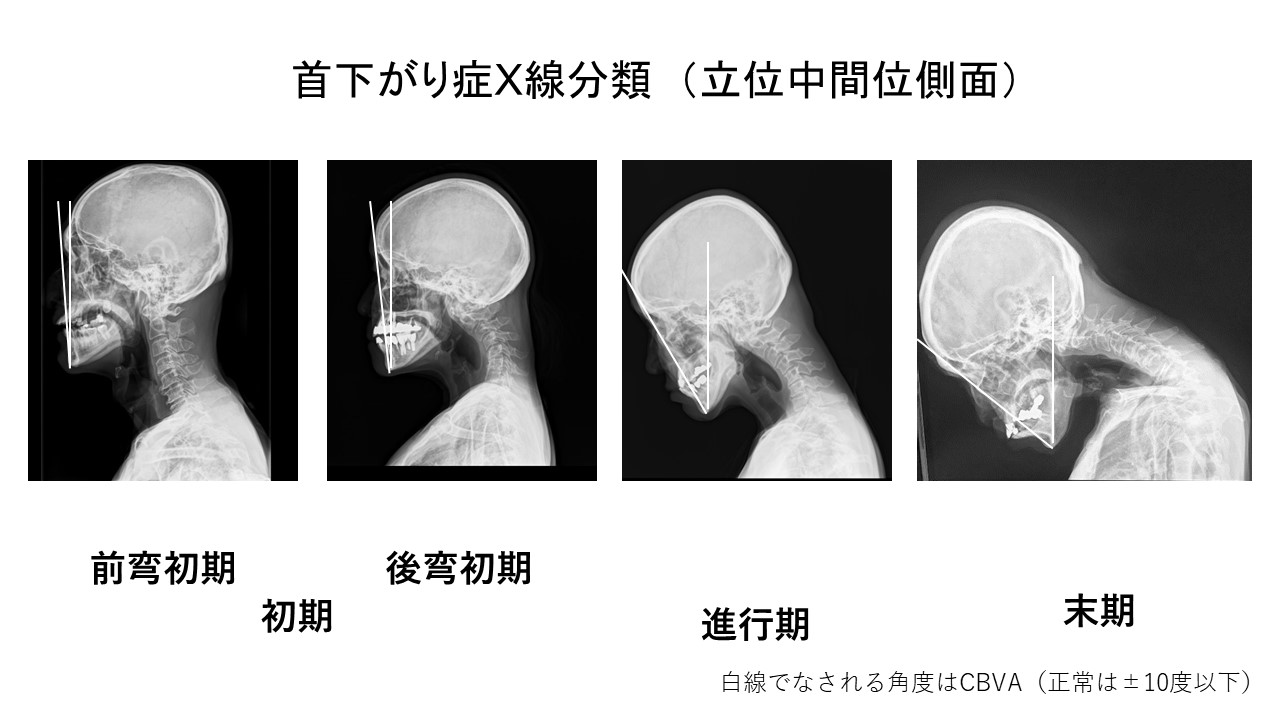 Dropped head syndrome (etiology and solution) | 東京医科大学 整形外科学分野